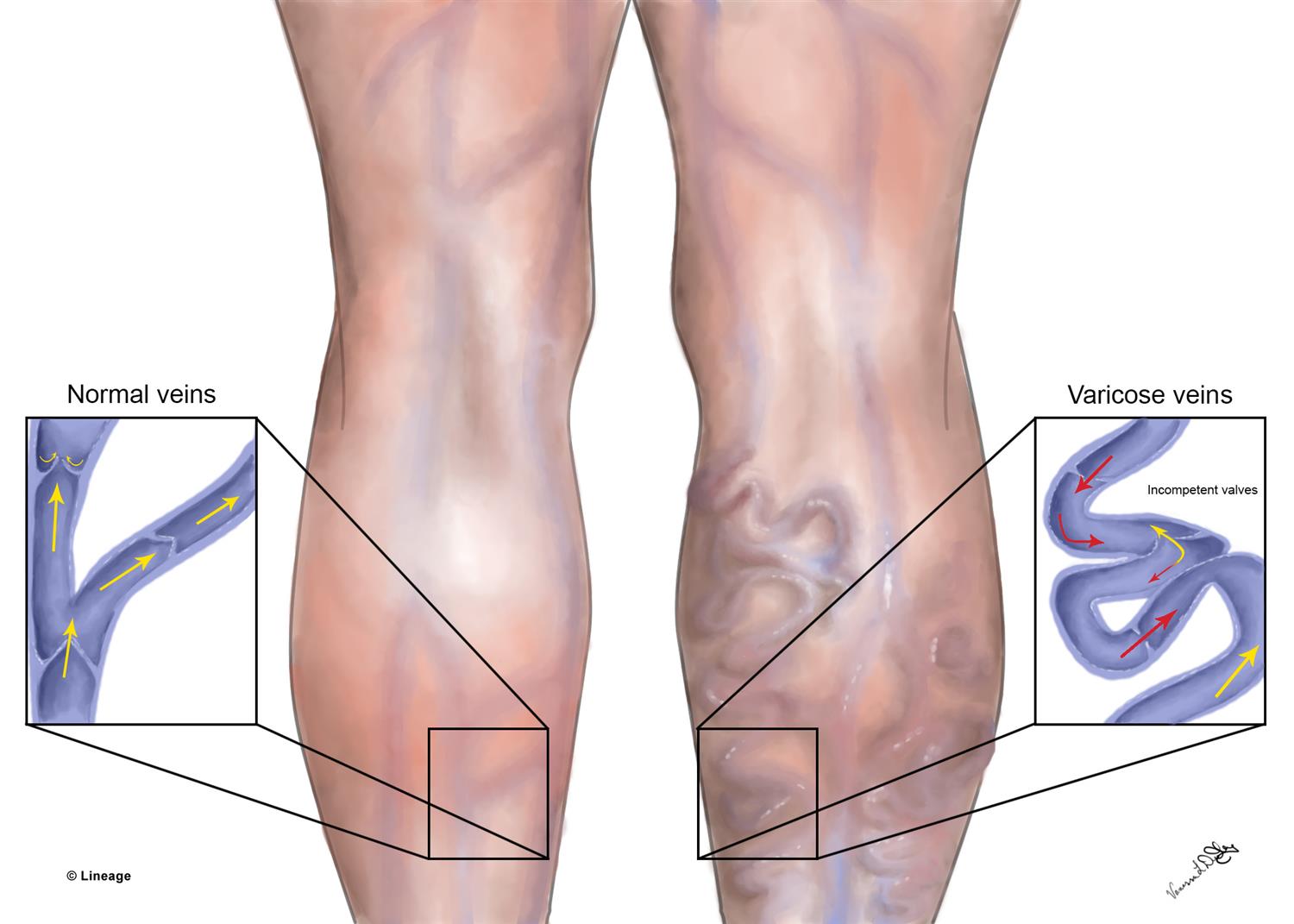 Varicose Veins USMLE Strike