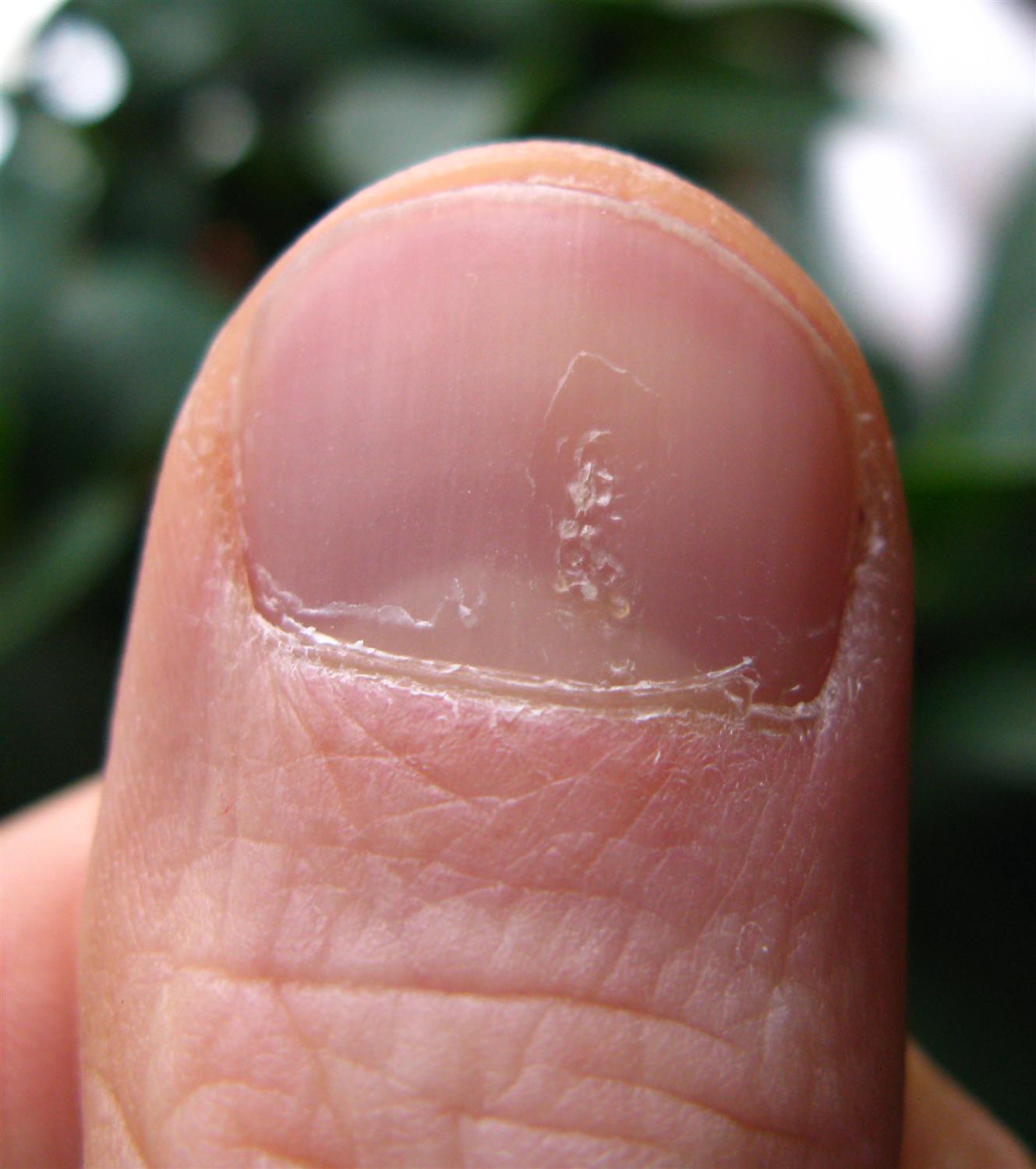 Nail Disorders Dermatology Medbullets Step 1 Nail Disorders Dermatology Medbullets Step 1