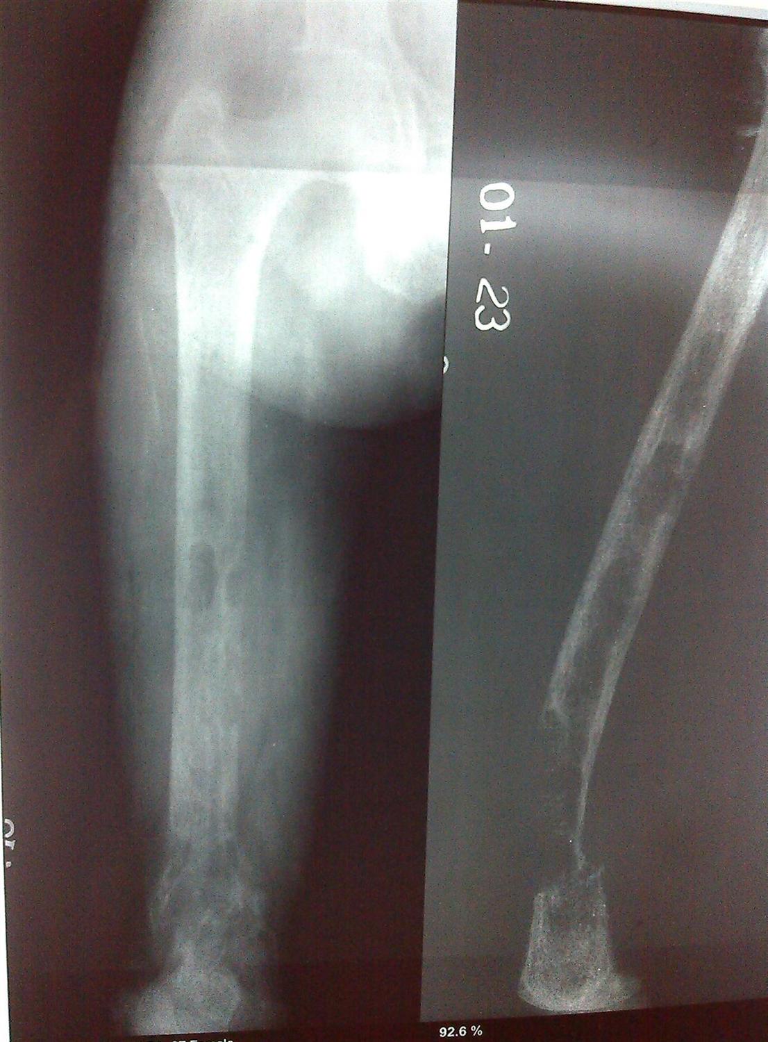 Hyperparathyroidism - Endocrine - Medbullets Step 1