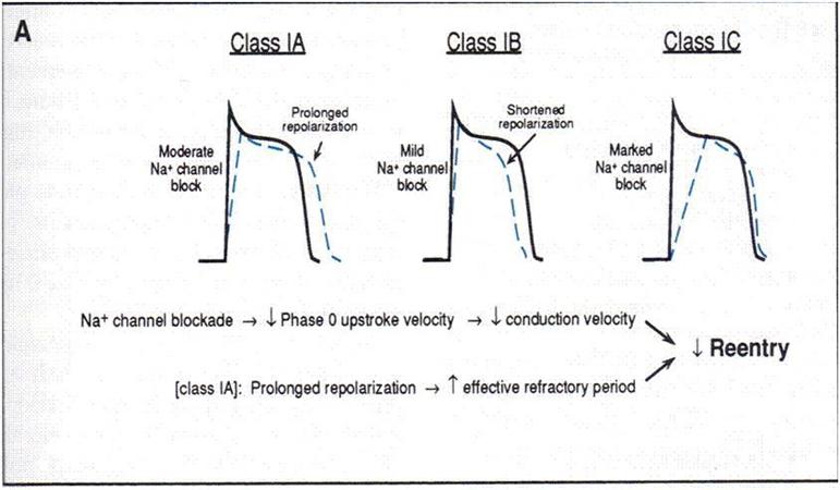 Antiarrhythmics - Cardiovascular - Medbullets Step 1