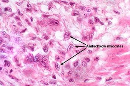 Rheumatic Heart Disease - Cardiovascular - Medbullets Step 1