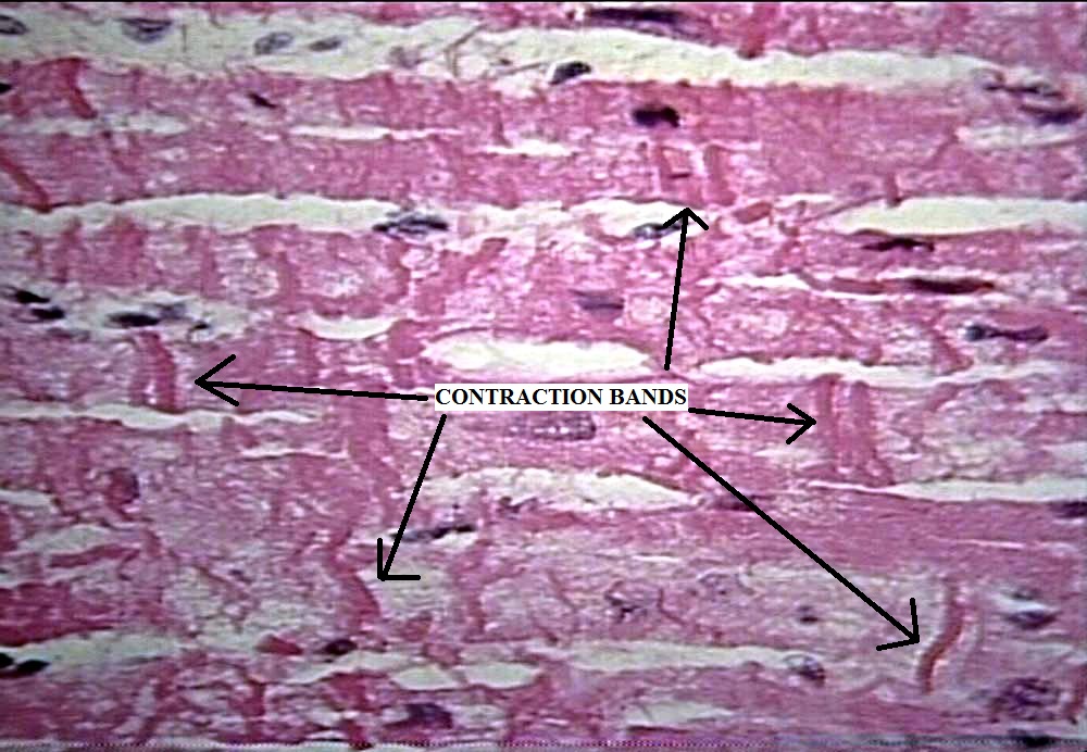 Myocardial Infarction - Cardiovascular - Medbullets Step 1