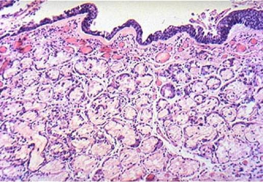 Chronic Bronchitis - Respiratory - Medbullets Step 1
