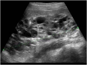 Adult Polycystic Kidney - Renal - Medbullets Step 2/3