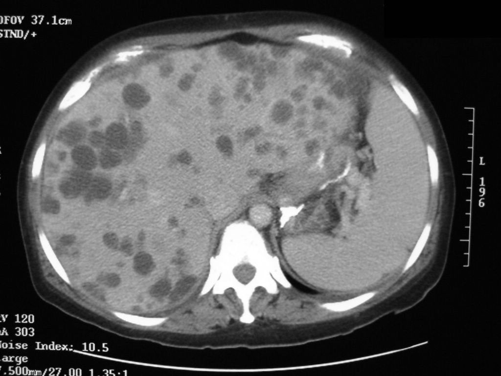 Adult Polycystic Kidney - Renal - Medbullets Step 2/3
