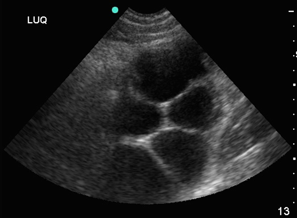 Adult Polycystic Kidney - Renal - Medbullets Step 2/3