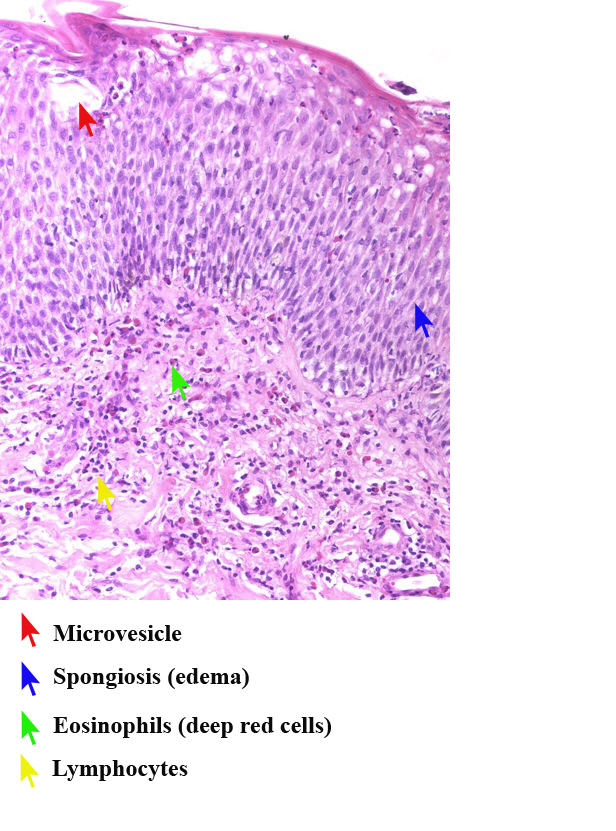 Contact Dermatitis - Dermatology - Medbullets Step 2/3