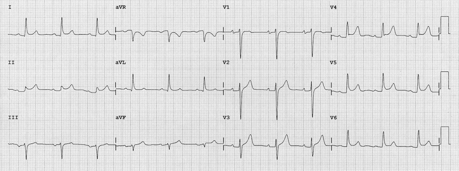 Pericarditis - Cardiovascular - Medbullets Step 2/3