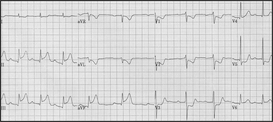 Myocardial Infarction - Cardiovascular - Medbullets Step 2/3