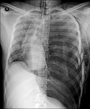 Tension Pneumothorax - Pulmonary - Medbullets Step 2/3