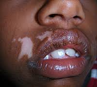 Vitiligo - Dermatology - Medbullets Step 2/3