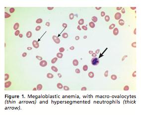Folic Acid Deficiency - Heme - Medbullets Step 2/3