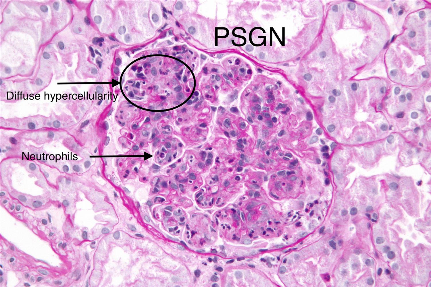 Diffuse Proliferative Glomerulonephritis Wire Looping A) Lupus Class
