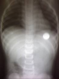 Foreign Body Aspiration - Pediatrics - Medbullets Step 2/3