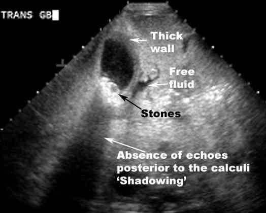 Acute Cholecystitis - Gastrointestinal - Medbullets Step 2/3