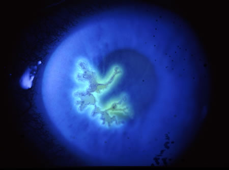 Herpes Zoster (Shingles) - Infectious Dis. - Medbullets Step 2/3