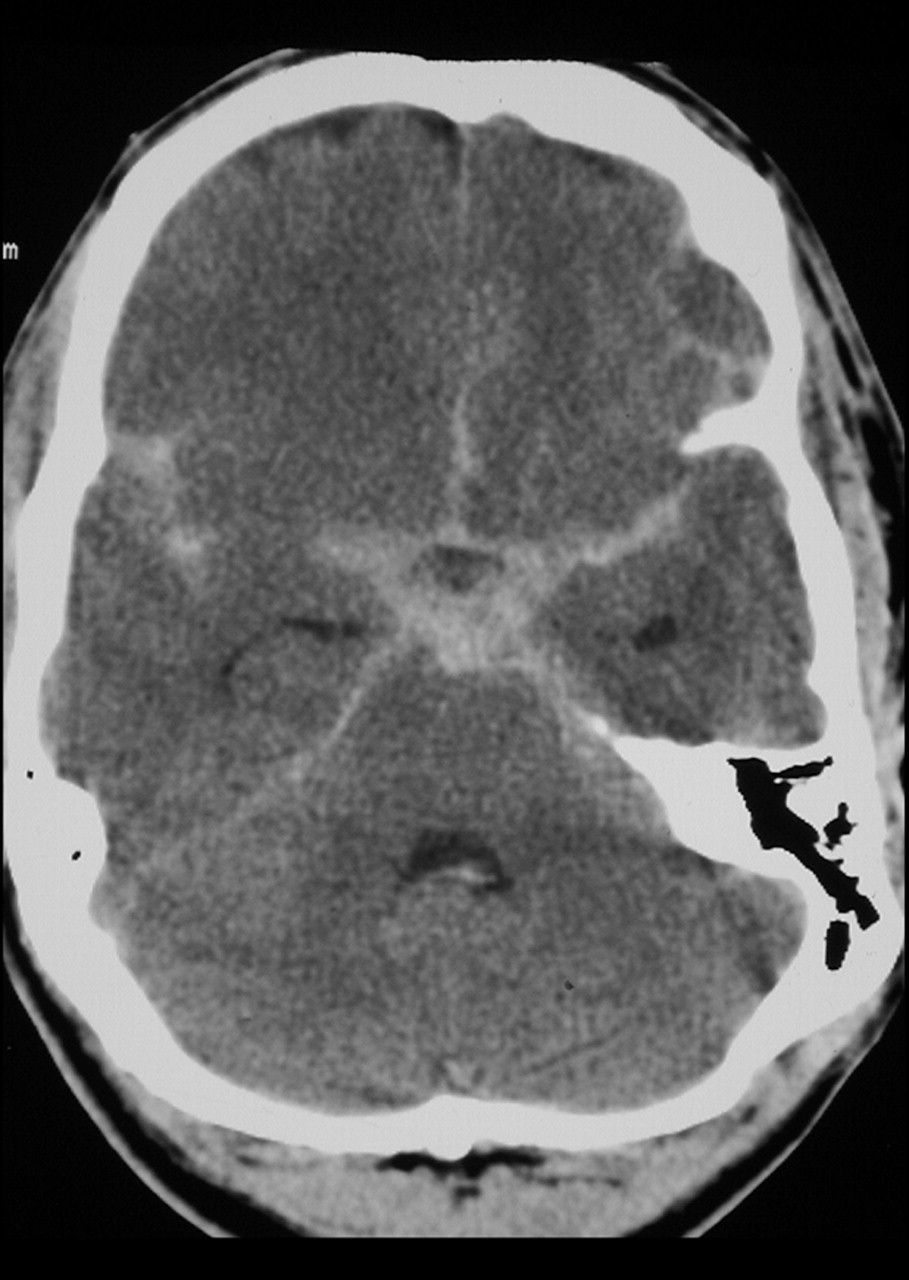 Subarachnoid Hemorrhage - Neurology - Medbullets Step 2/3