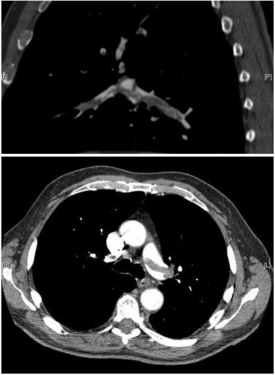 Cardiogenic Shock - Cardiovascular - Medbullets Step 2/3