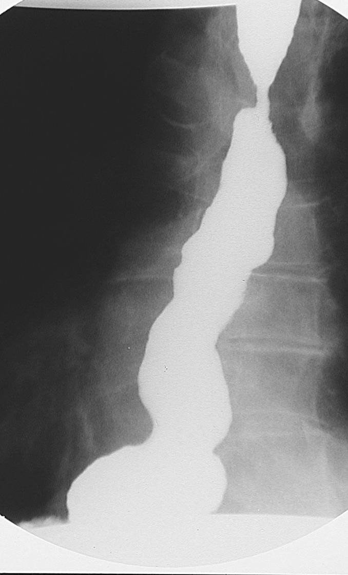 Diffuse Esophageal Spasm - Gastrointestinal - Medbullets Step 2/3