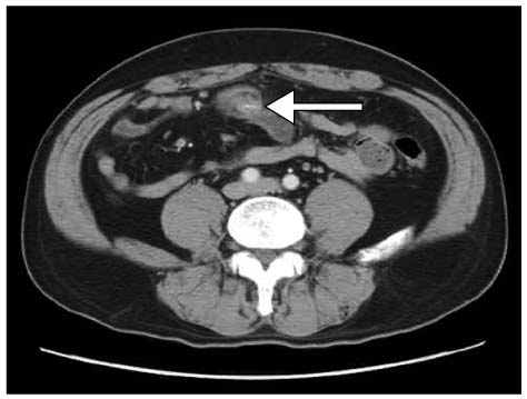 Post-Operative Fever - Infectious Dis. - Medbullets Step 2/3