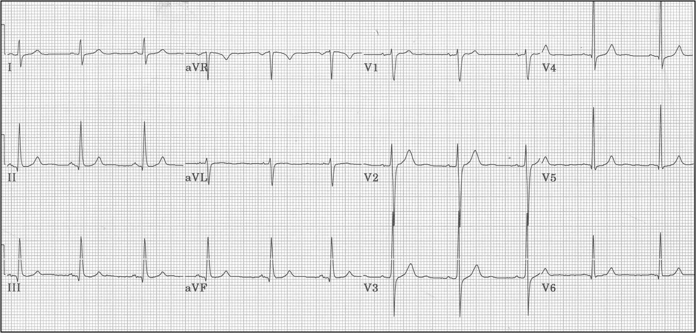 Blunt Cardiac Injury - Cardiovascular - Medbullets Step 2/3