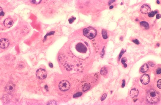 Cytomegalovirus (CMV) - Microbiology - Medbullets Step 1