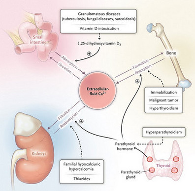 Hypercalcemia - Endocrine - Medbullets Step 1