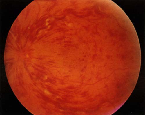 Retinal Artery Occlusion / Amaurosis Fugax - Ophthalmology - Medbullets ...