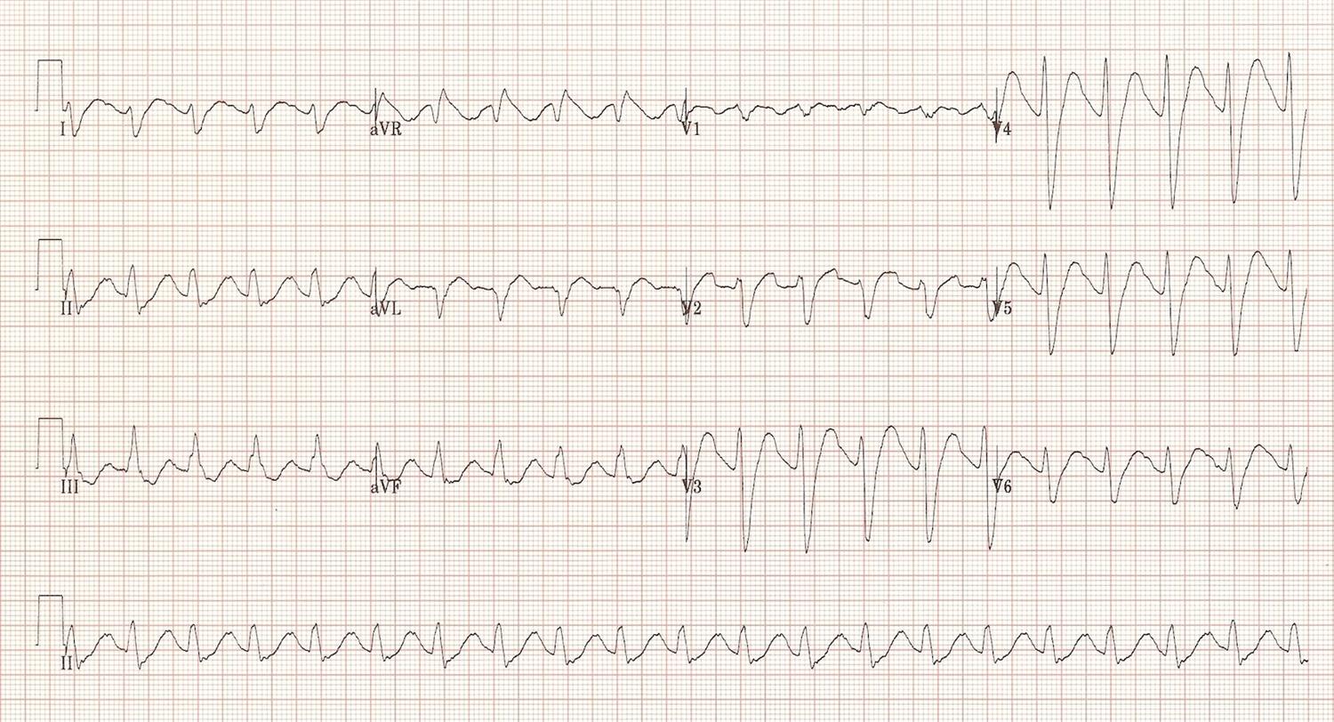 Tricyclic Antidepressants (TCAs) - Psychiatry - Medbullets Step 2/3