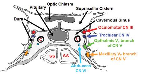 Cavernous Sinuses - Neurology - Medbullets Step 1