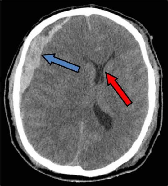 Question 106884 - Qbank - Medbullets Step 2/3