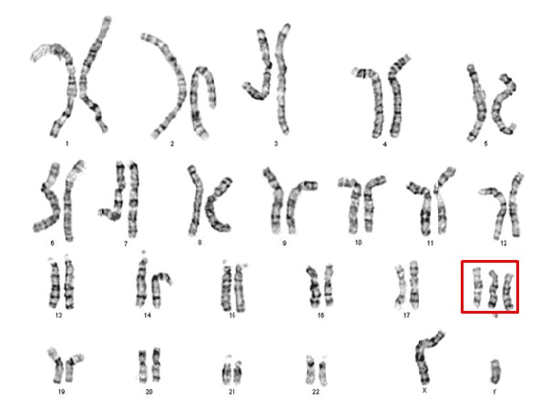 Xo Karyotype