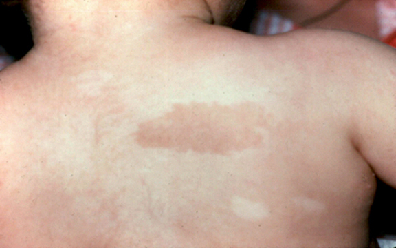 Anemia of Chronic Disease - Heme - Medbullets Step 2/3