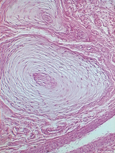 Lysosome - Biochemistry - Medbullets Step 1