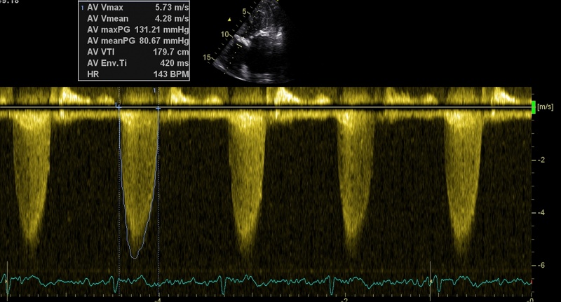 Aortic Stenosis - Cardiovascular - Medbullets Step 2/3