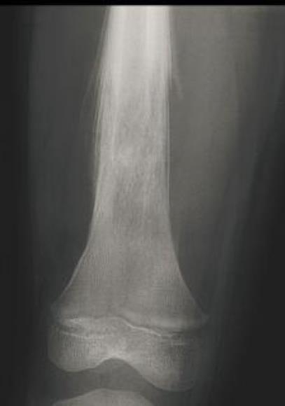 Malignant Bone Tumors - Oncology - Medbullets Step 1