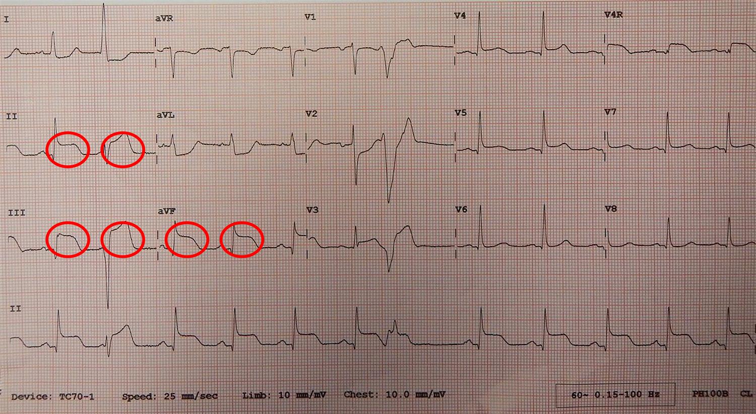 Question 108984 - Qbank - Medbullets Step 2/3