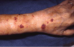 Senile Purpura