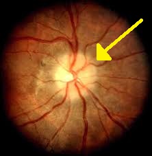 Question 213562 - Qbank - Medbullets Step 2/3