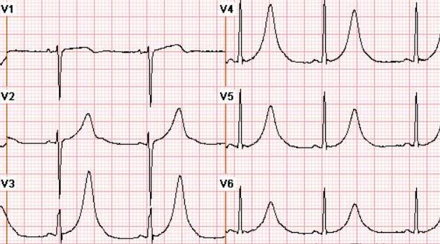 Myocardial Infarction - Cardiovascular - Medbullets Step 2/3
