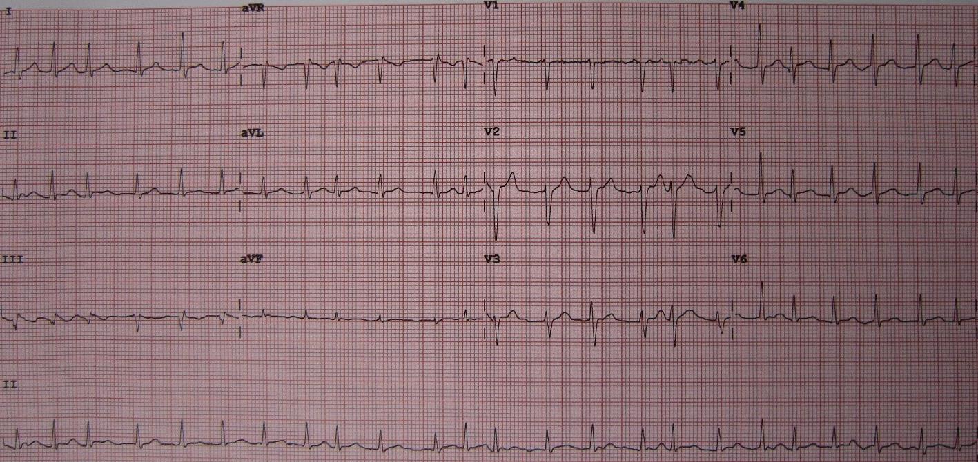 Atrial Fibrillation - Cardiovascular - Medbullets Step 2/3