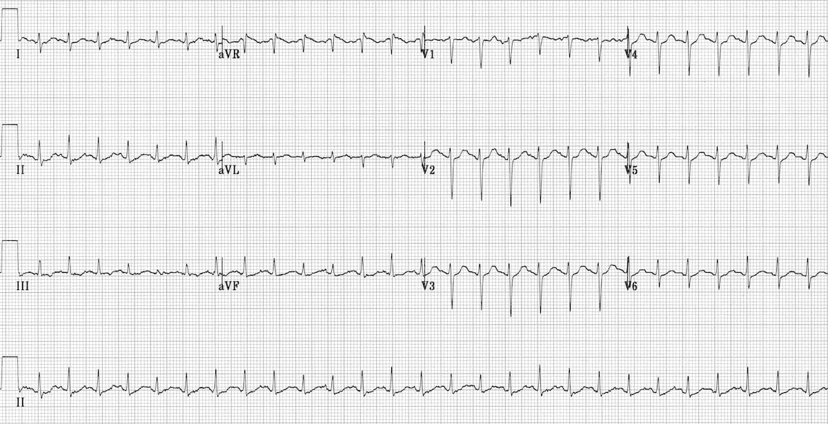 Distributive Shock - Cardiovascular - Medbullets Step 2/3