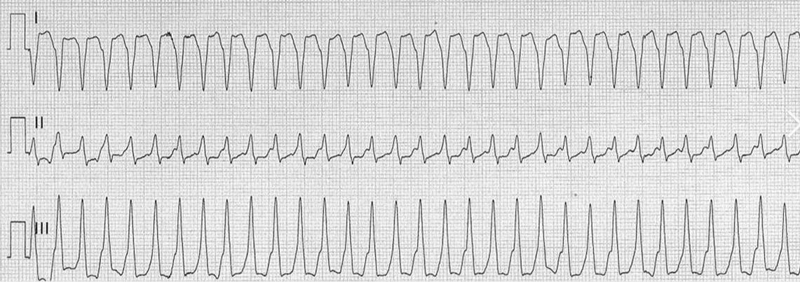 Wolff-Parkinson-White (WPW) Syndrome - Cardiovascular - Medbullets Step 2/3
