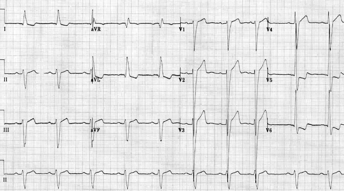 Syncope - Cardiovascular - Medbullets Step 2/3