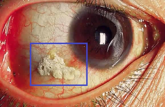Question 217073 - Qbank - Medbullets Step 1
