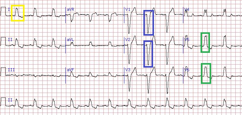 Question 218262 - Qbank - Medbullets Step 2/3