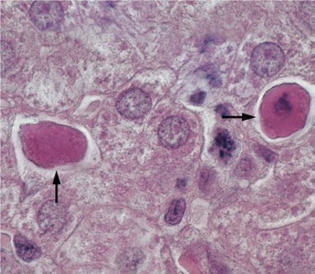 Yellow Fever Virus - Microbiology - Medbullets Step 1