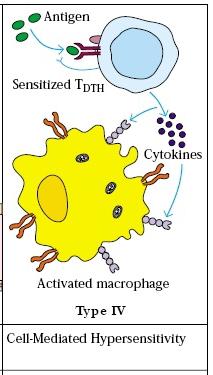 Hypersensitivity - Immunology - Medbullets Step 1