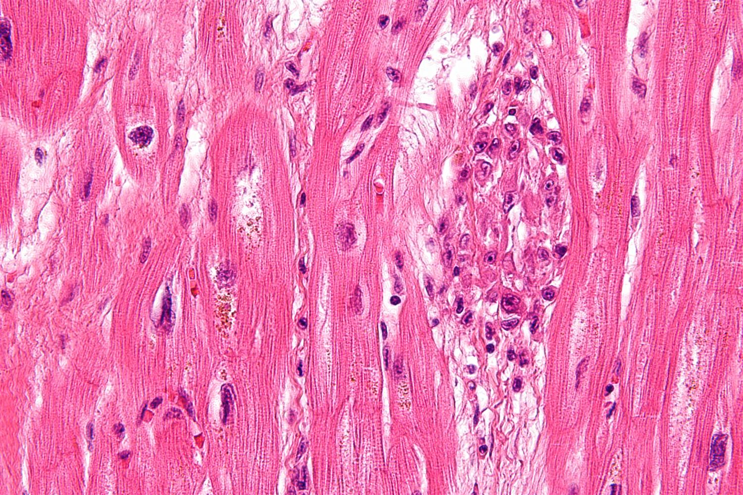 Rheumatic Heart Disease Cardiovascular Medbullets Step 1