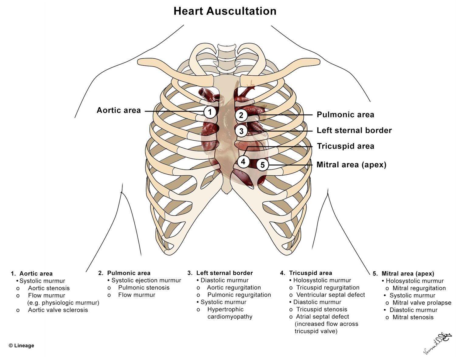 Valvular Disease Cardiovascular Medbullets Step 1 Valvular Disease Cardiovascular Medbullets Step 1